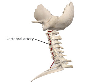 Understanding Vertebrobasilar Insufficiency - Academy of Clinical Massage